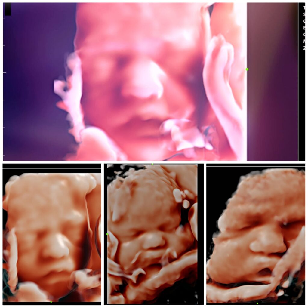 Exploring the Precision of 5-D Ultrasounds in Prenatal Imaging - Dr ...